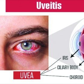 Factors Increasing Risk Of Uveitis By Dr. Naveen Gupta - Gust